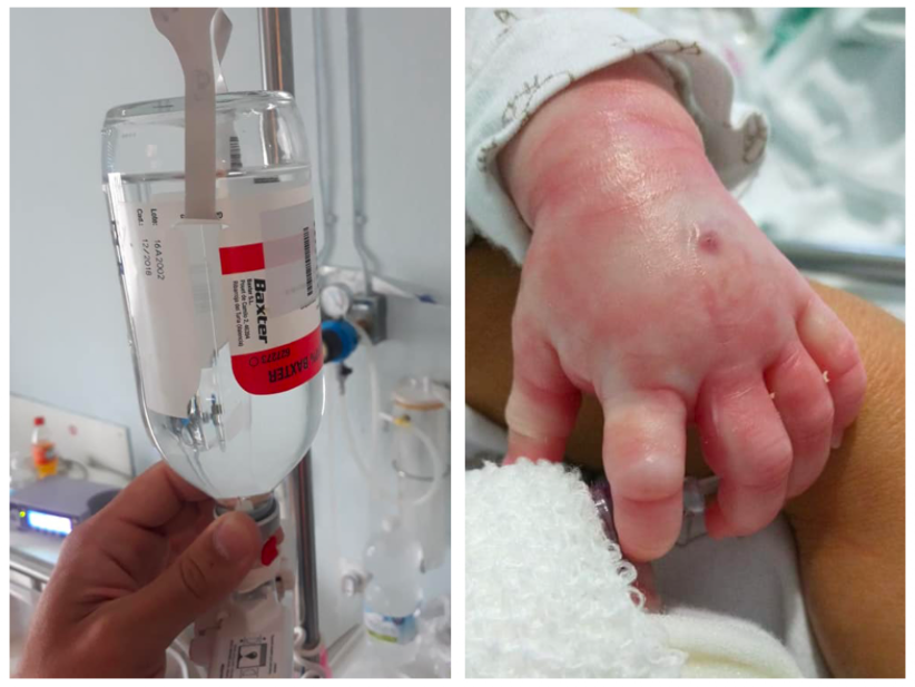 Flebitis En El Brazo Aderontsteking (flebitis): Symptomen En